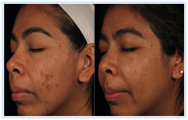 Laser: Benefits & Protocols - Toronto Dermatology Centre