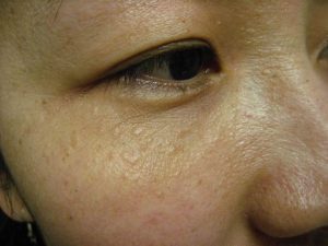 Syringomas: Symptoms, Causes, & Treatment - Toronto Dermatology Centre