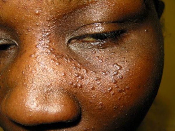 Syringomas: Symptoms, Causes, & Treatment - Toronto Dermatology Centre