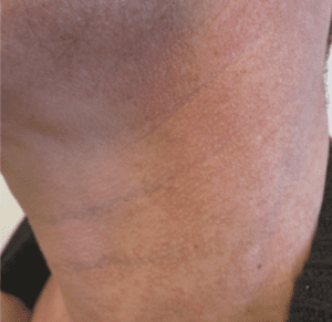 Poikiloderma of Civatte - Toronto Dermatology Centre