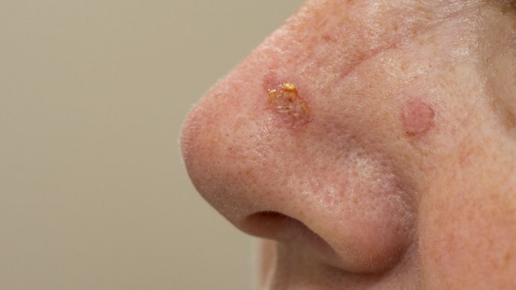 Actinic Keratosis: Symptoms, Causes, & Treatment - Toronto Dermatology ...