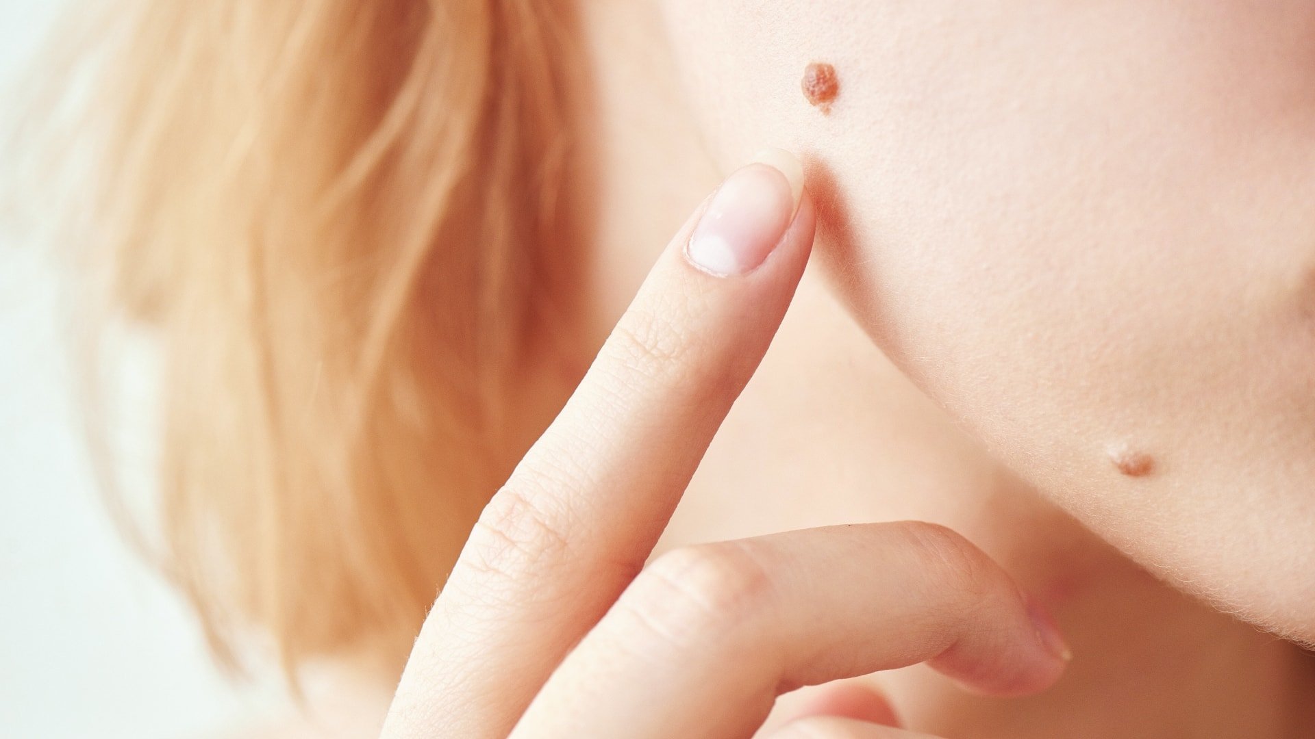 Benign Skin Growths Causes Treatment Prevention Toronto
