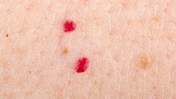 Cherry Angiomas: Diagnosis & Treatment - Toronto Dermatology Centre