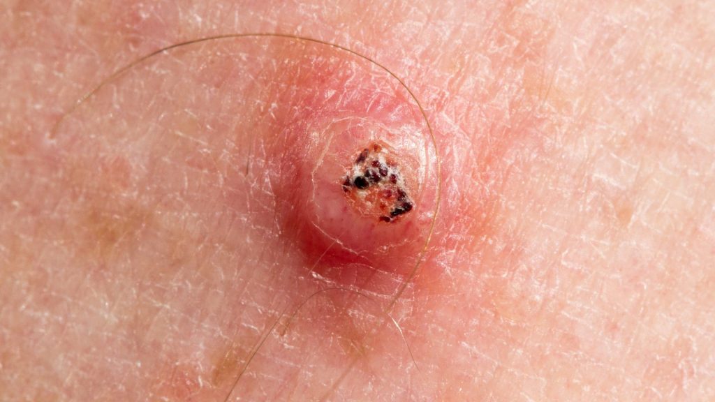 Keratoacanthoma Ka