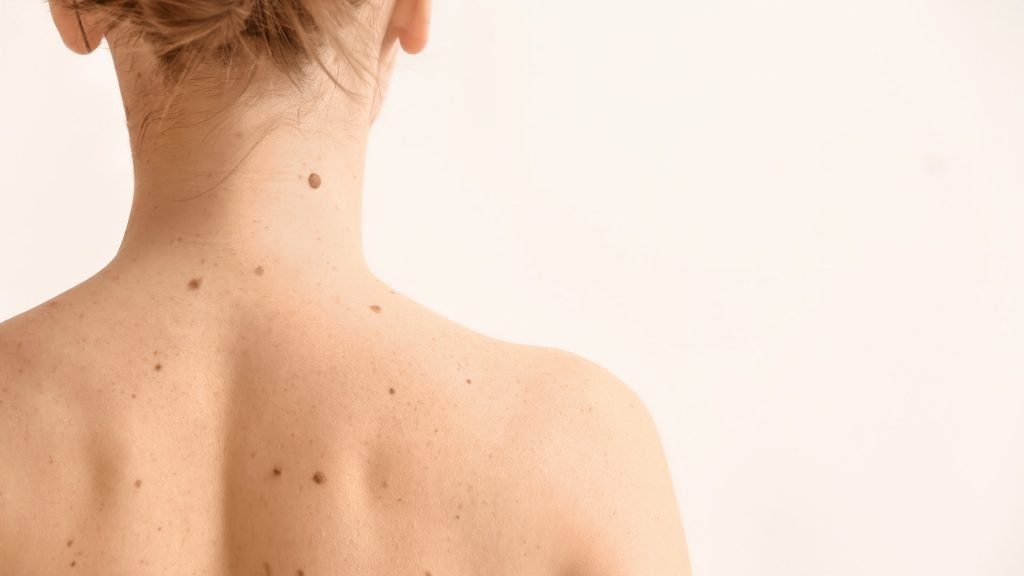 Expert Mole Removal - Toronto Dermatology Centre