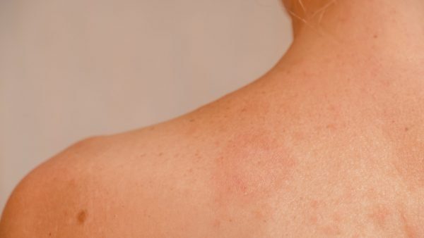 Pityriasis Rocea: Symptoms, Causes, & Treatment - Toronto Dermatology ...