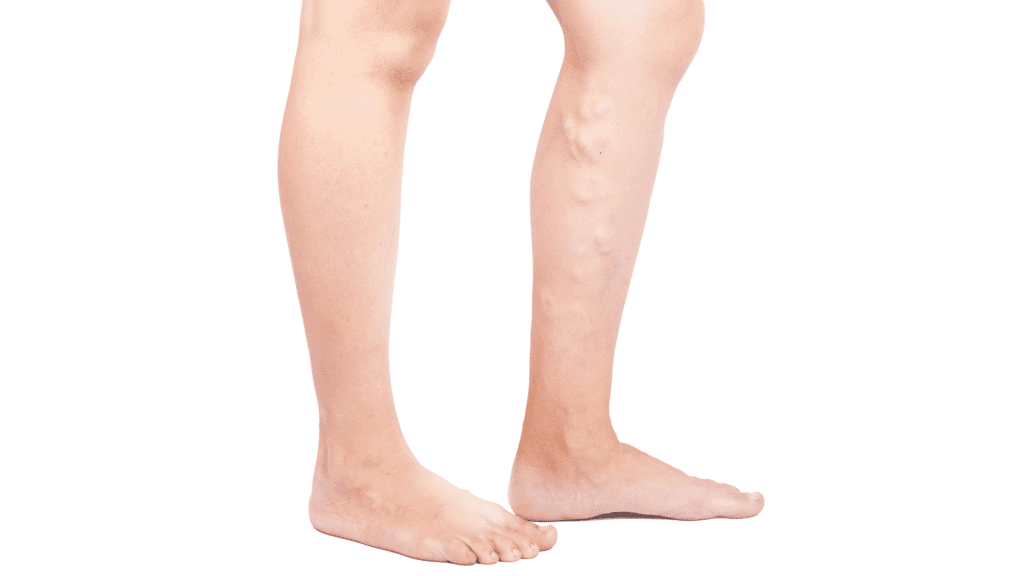 Varicose & Spider Vein Treatment - Toronto Dermatology Centre