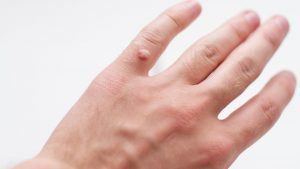 Wart Treatment and Removal - Toronto Dermatology Centre