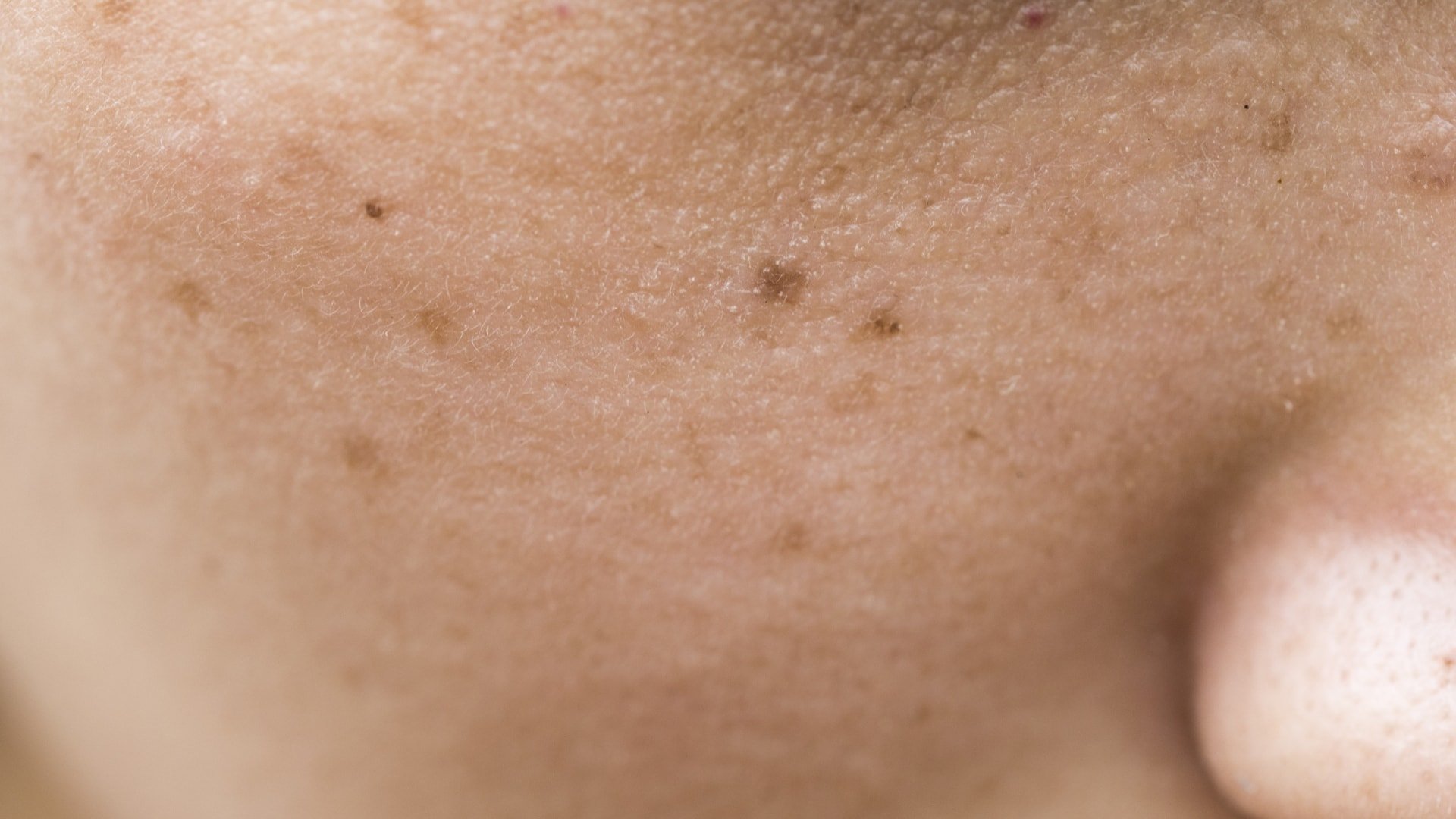 Melasma Toronto Dermatology Centre Melasma Toronto Dermatology Centre