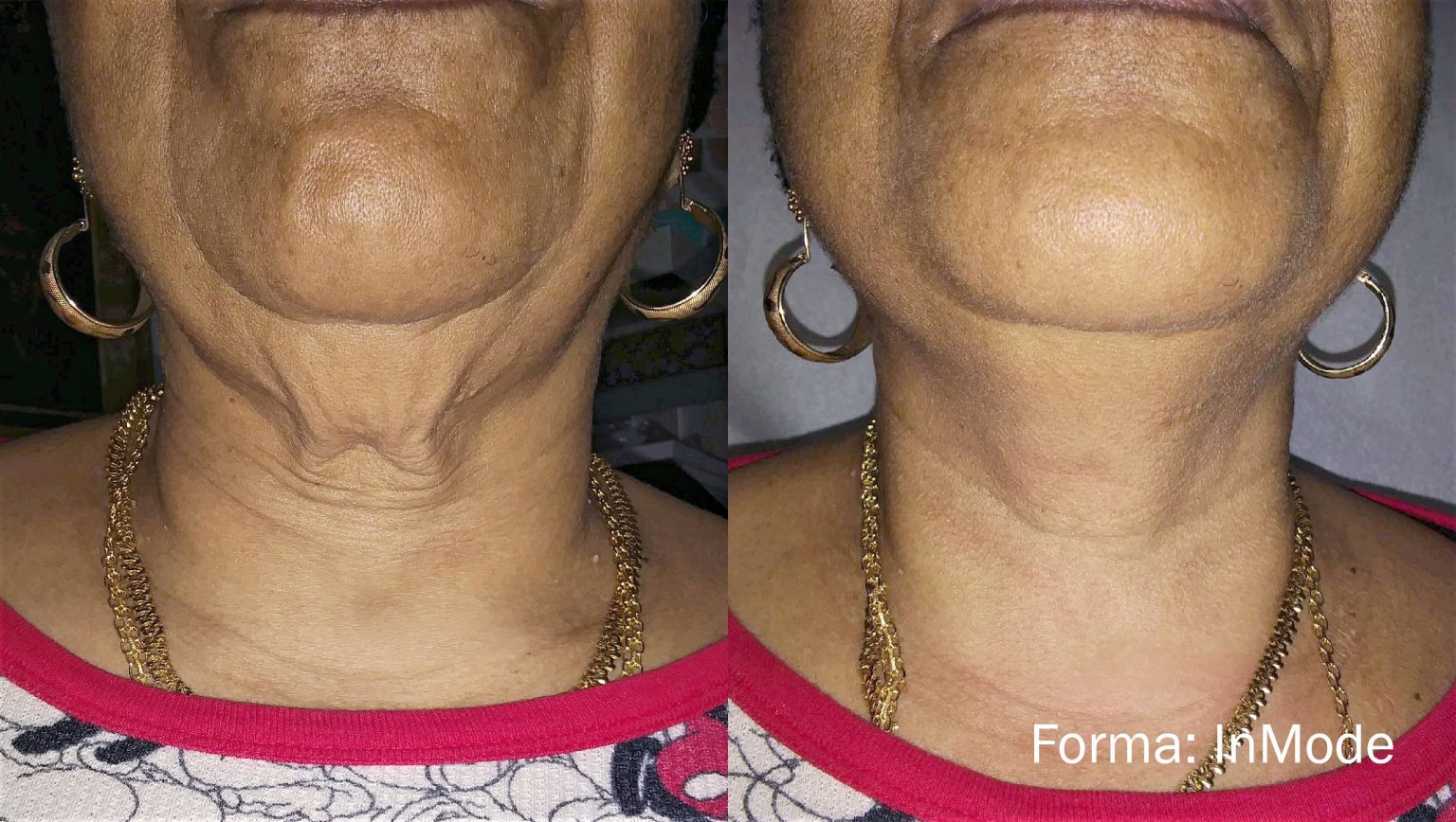 Face & Body Skin Tightening - Toronto Dermatology Centre