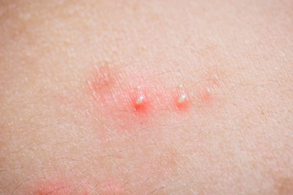 How Do I Deal With Body Acne? - Toronto Dermatology Centre