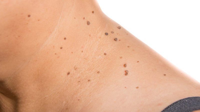 What causes skin tag? - Toronto Dermatology Centre