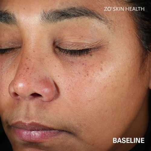 ZO Illuminating AOX Serum - Toronto Dermatology Centre