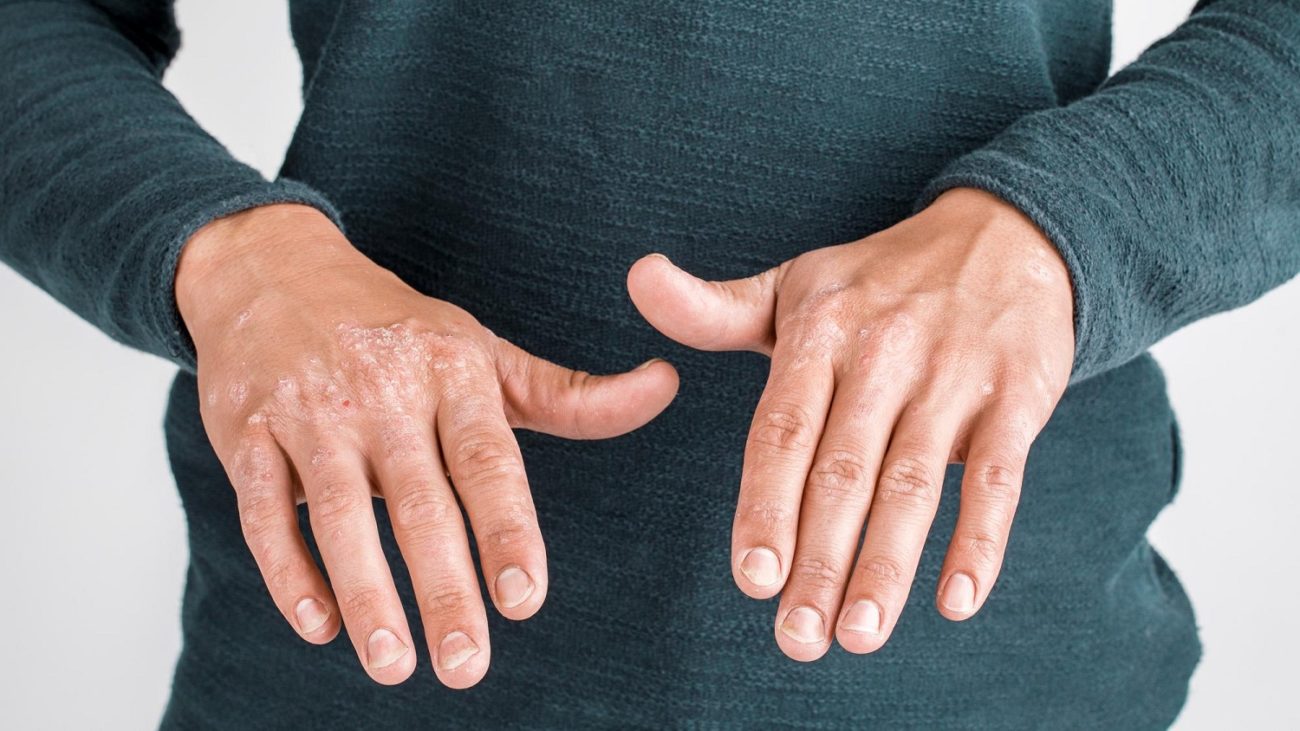 Moderate to Severe Plaque Psoriasis Research (24 Weeks)