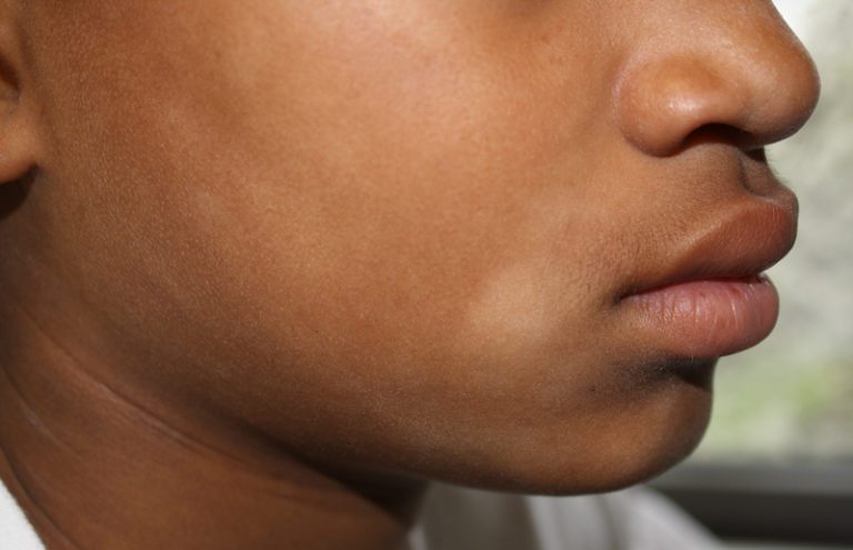 Pityriasis Alba: Symptoms, Causes, & Treatment - Toronto Dermatology Centre