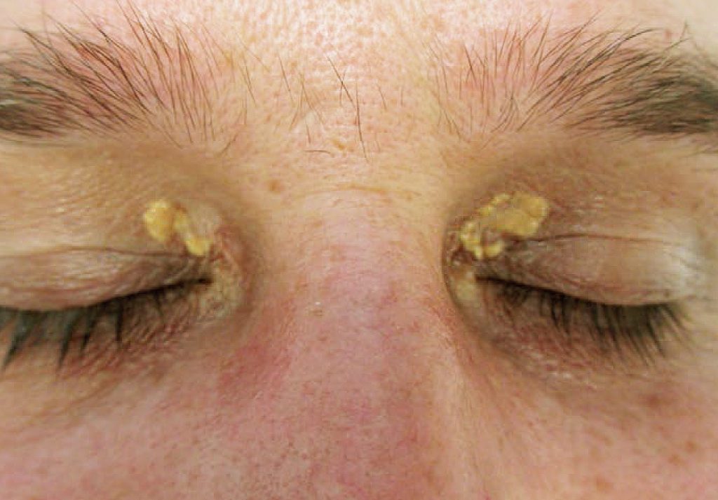 Xanthelasma Cholesterol Deposits: Causes & Treatment - Toronto ...