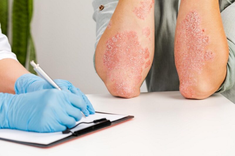 Moderate to Severe Psoriasis Study (20 Weeks)