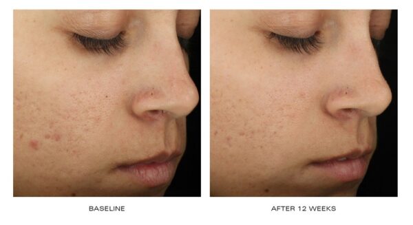 ZO Complexion Clarifying Serum - Toronto Dermatology Centre