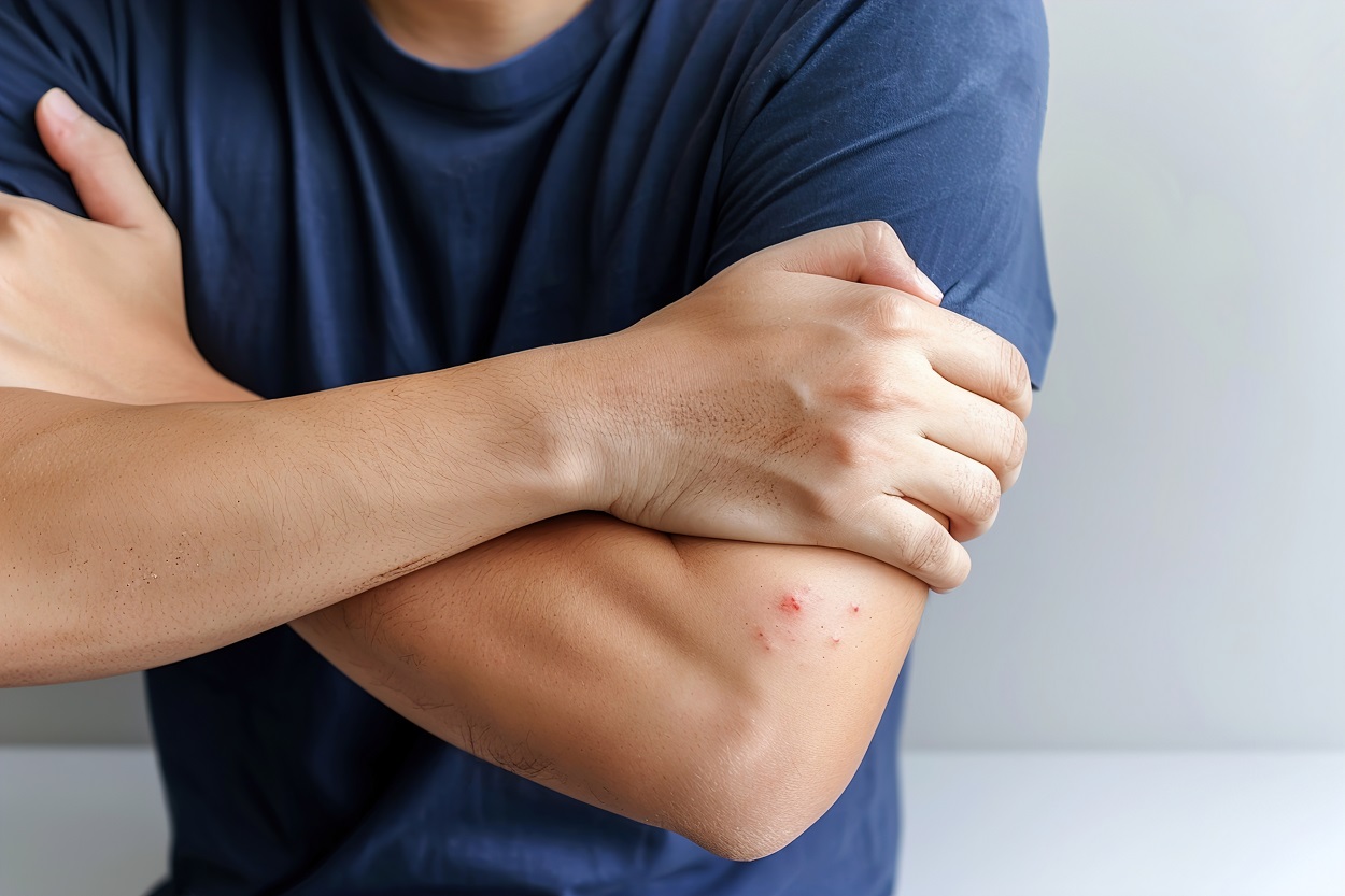 Open-Label Clinical Trial for Atopic Dermatitis (180 Weeks)