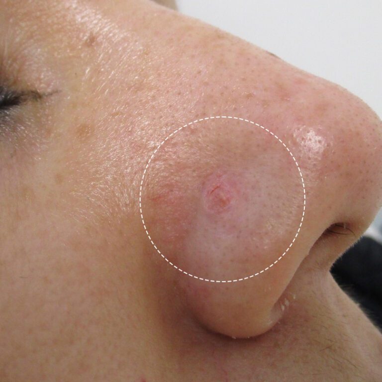 Expert Mole Removal - Toronto Dermatology Centre