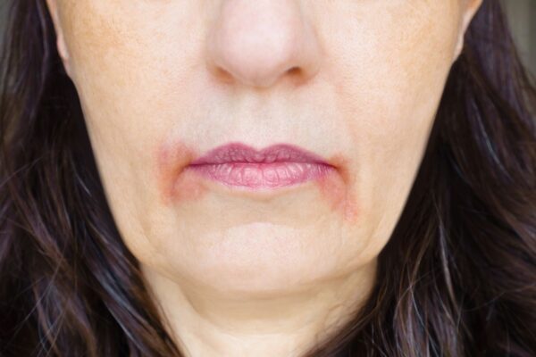 Perioral Dermatitis: Symptoms, Causes, & Treatment - Toronto ...