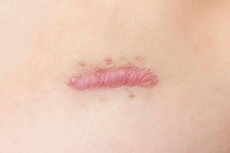 Scars - Toronto Dermatology Centre